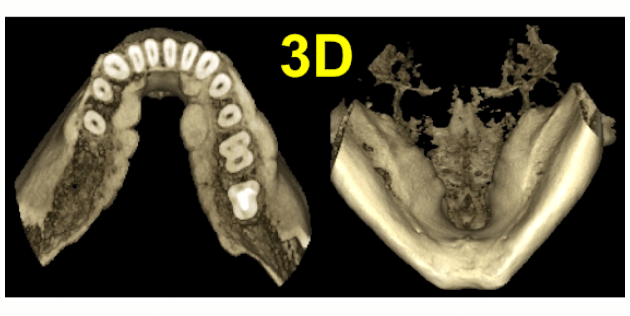 Torus mandibular - CIDEM, S.C.