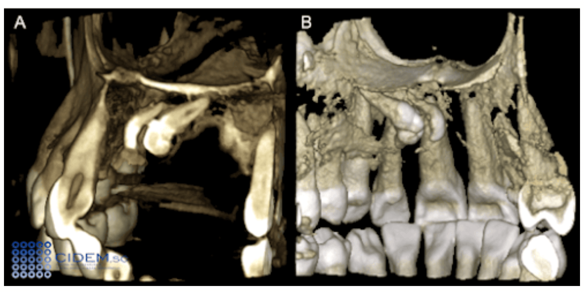 Diente supernumerario asociado a odontoma compuesto - CIDEM