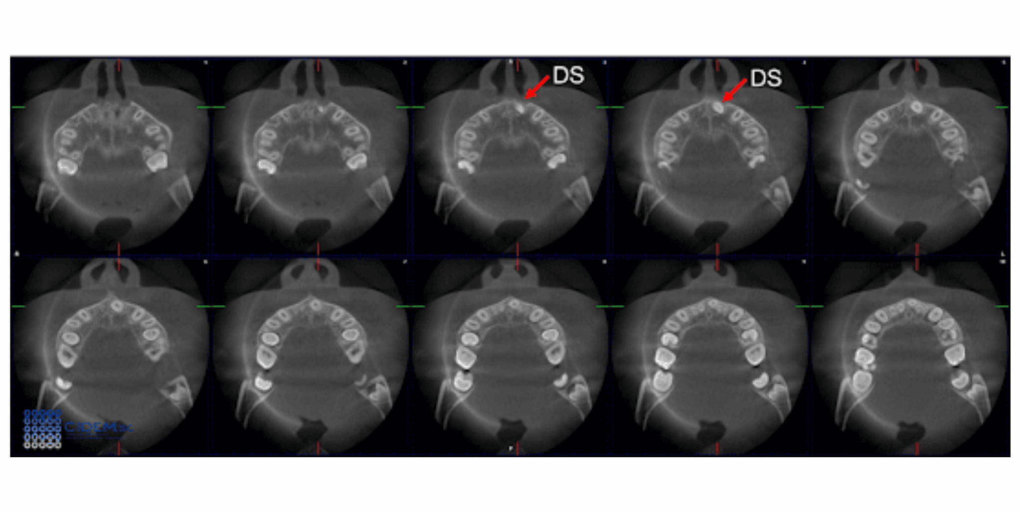 Mesiodens invertido - CIDEM, S.C.