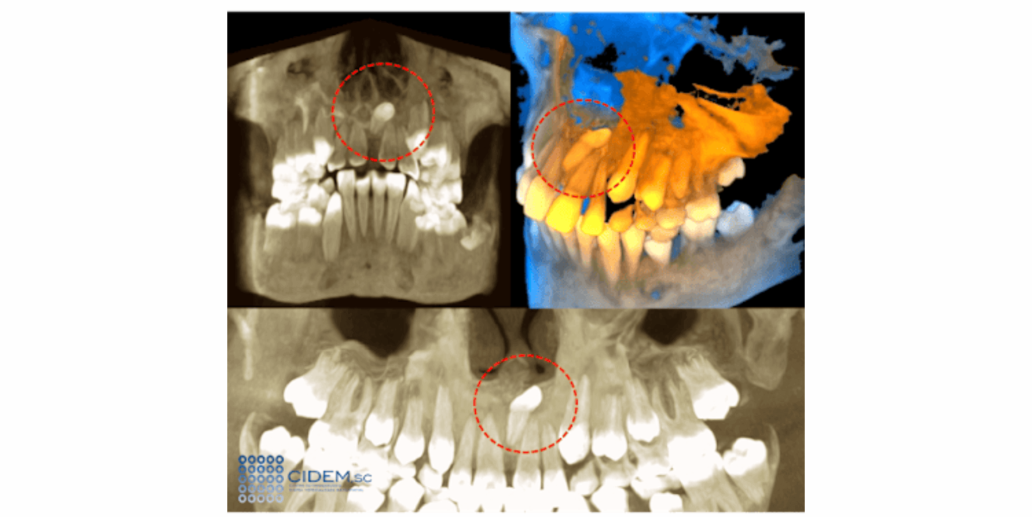 Mesiodens invertido - CIDEM, S.C.
